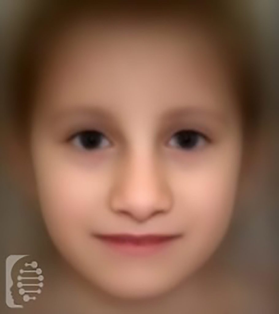 Floating-Harbor Syndrome OMIM# 136140 - FDNA