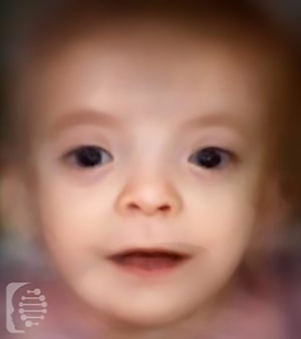 Lenz-Majewski Syndrome OMIM# 151050 - FDNA