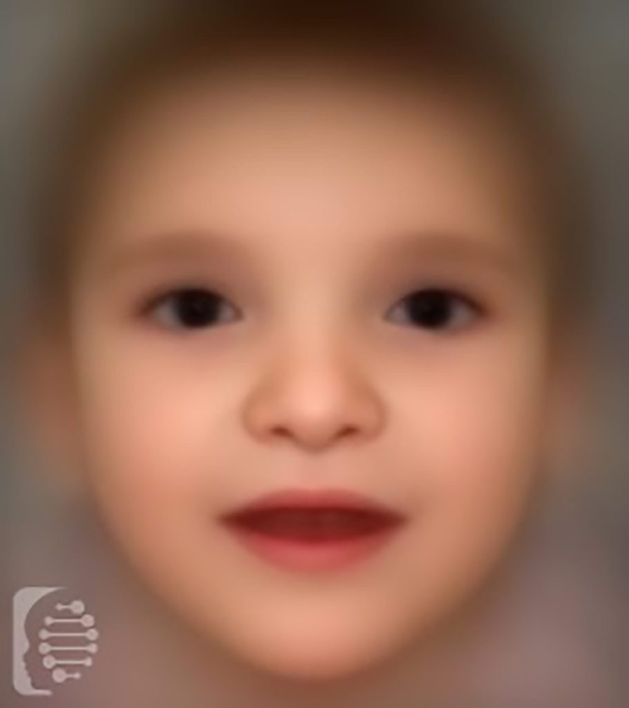 Mowat-Wilson Syndrome OMIM# 235730 - FDNA™