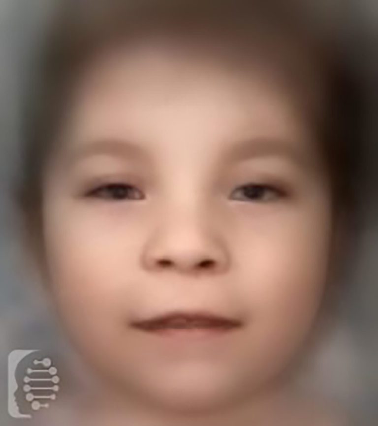 Peters-Plus Syndrome OMIM# 261540 - FDNA